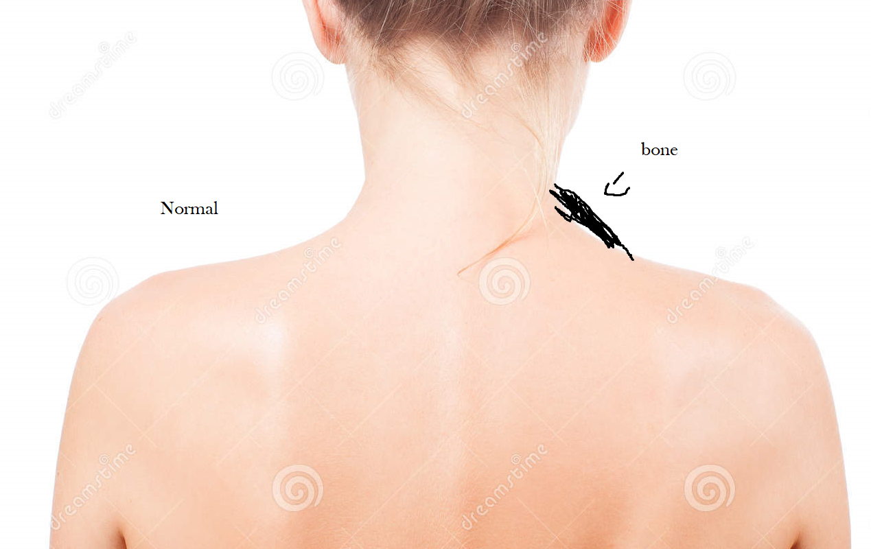 I feel like I have an extra bone in my shoulder? : r/AskDocs